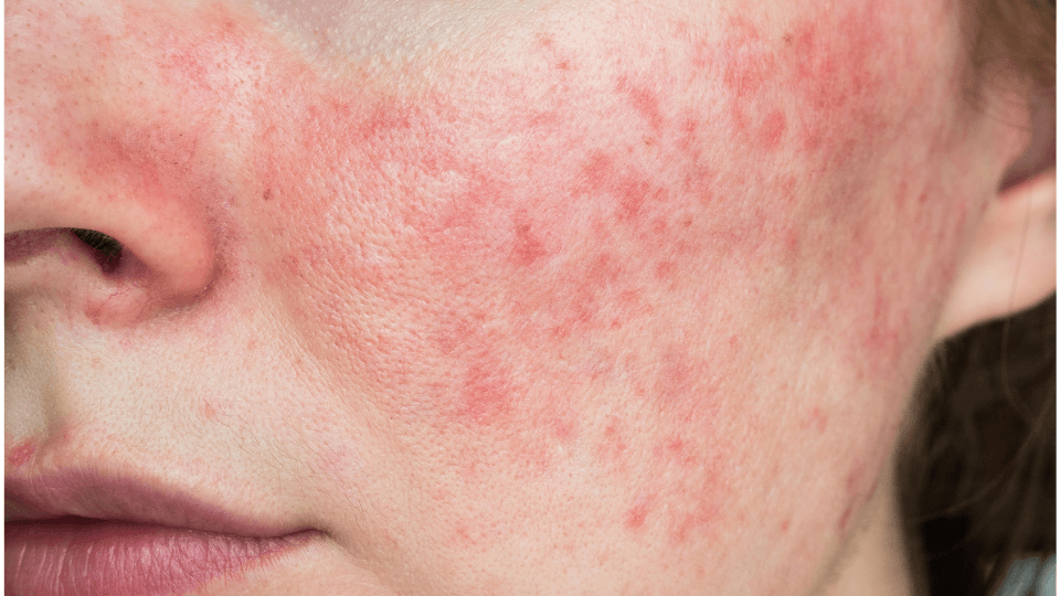 Ciri-Ciri Wajah yang Terkena Merkuri dan Cara Mengatasinya