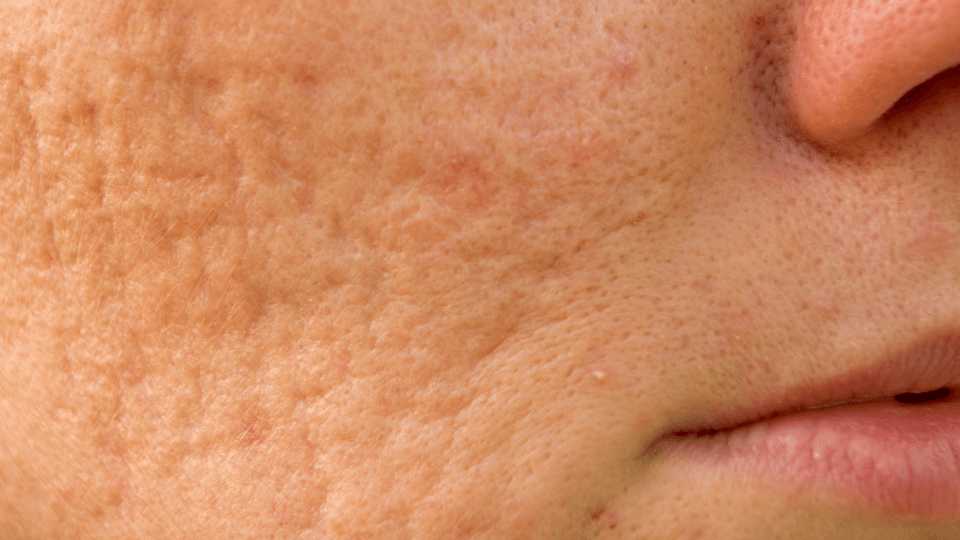 Apa Itu Ice Pick Scars? Ini Penyebab dan Cara Menghilangkannya