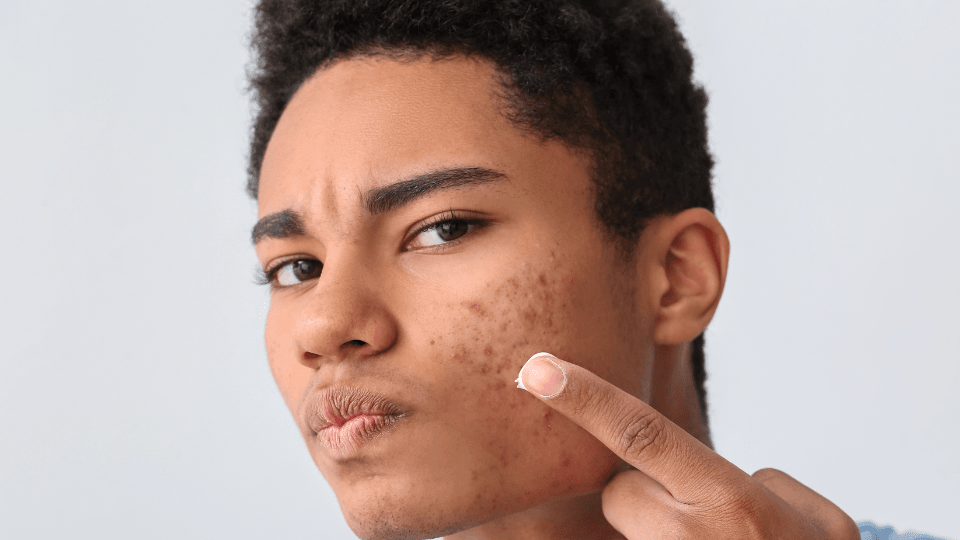 Jerawat Pustula: Pengertian, Penyebab, dan Cara Mengatasinya